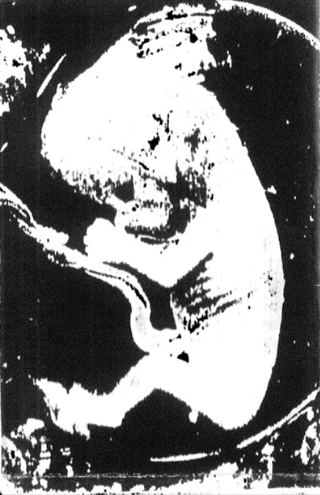 Embryonic Uterogestation by Disastrous Murmur (EP, Death Metal ...